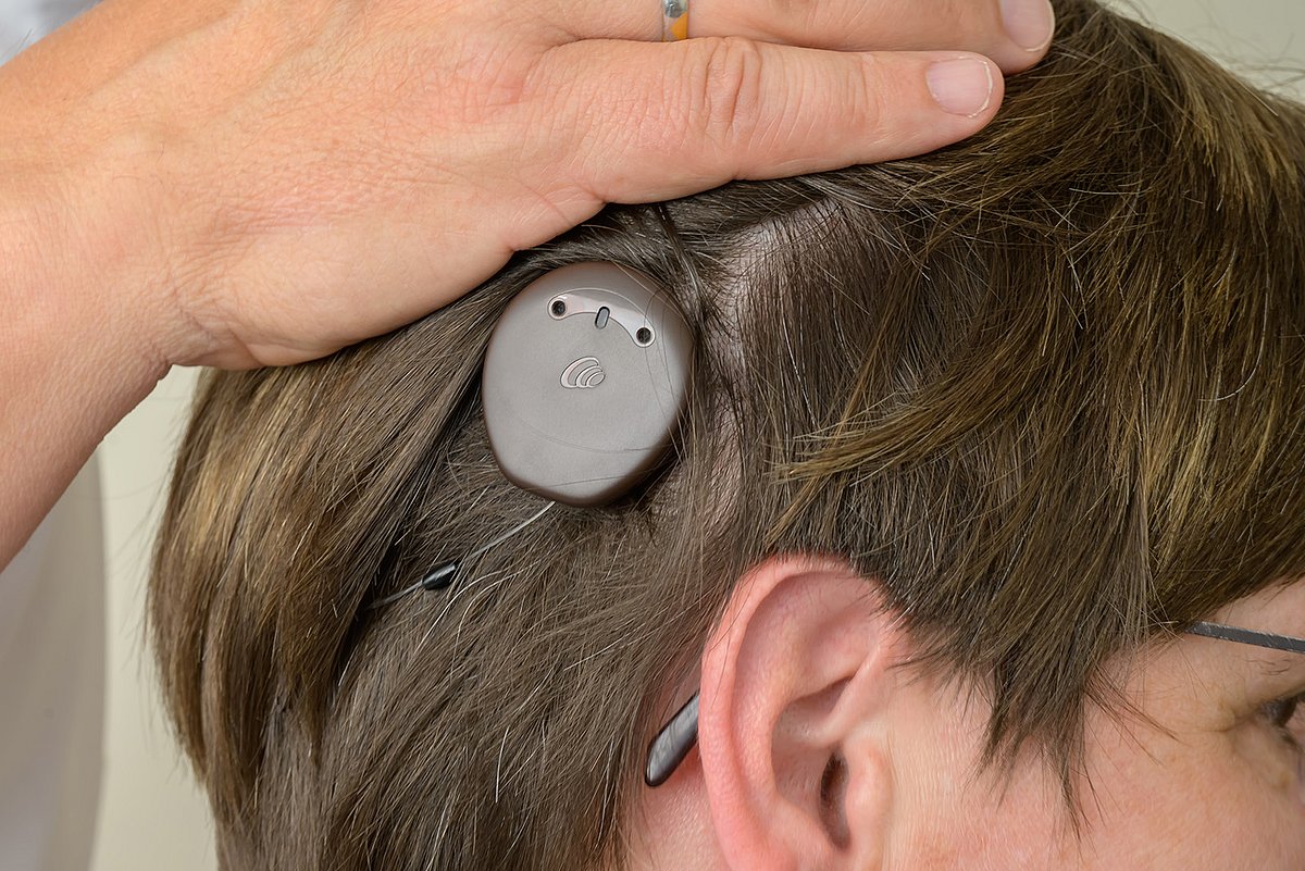 Smartes Cochlea-Implantat hilft, wenn Hörgeräte versagen